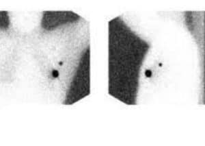 Lymphoscintigraphy Scan in Chandigarh at best price- 8699572364