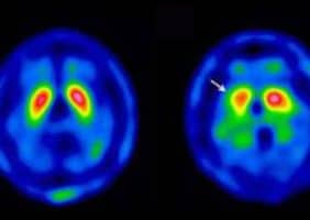 Trodat Spect Scan Archives - MRI Chandigarh