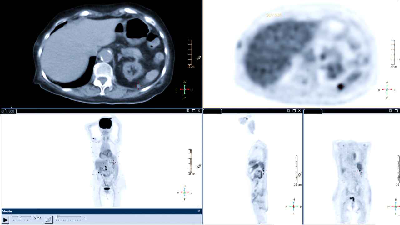 Whole Body PET CT Scan Near Me - MRI Chandigarh
